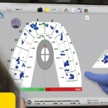 Solving Occlusion Confusion with Comprehensive Digital Bite Analysis | Tekscan